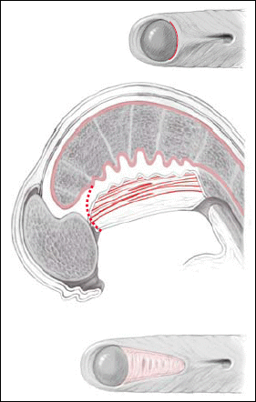 Hypospadias Surgery | Hypospadie Zentrum - Meatus, Repair - PROF. DR ...